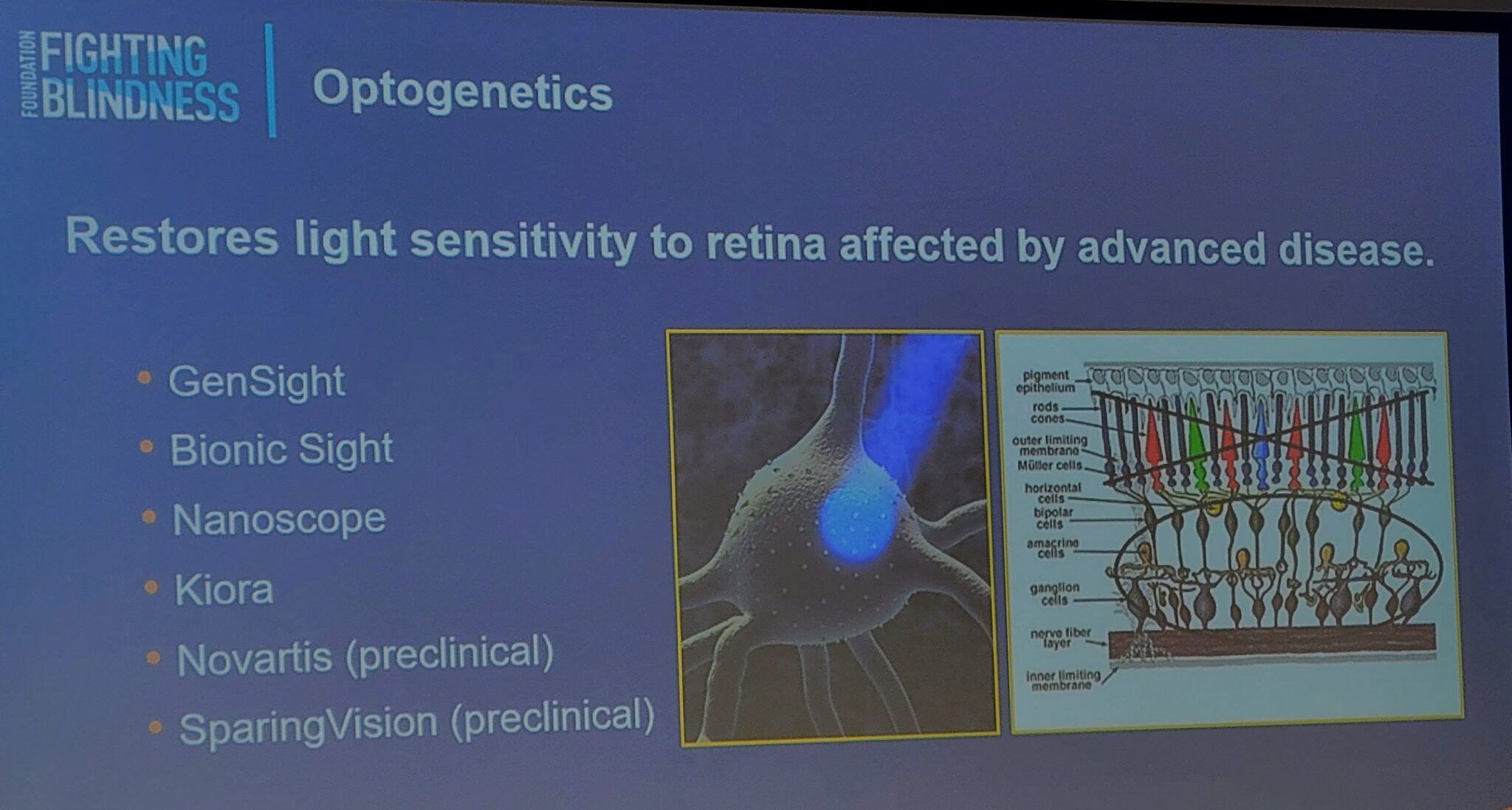 Understanding Age-Related Macular Degeneration- Dry, Geographic Atrophy ...