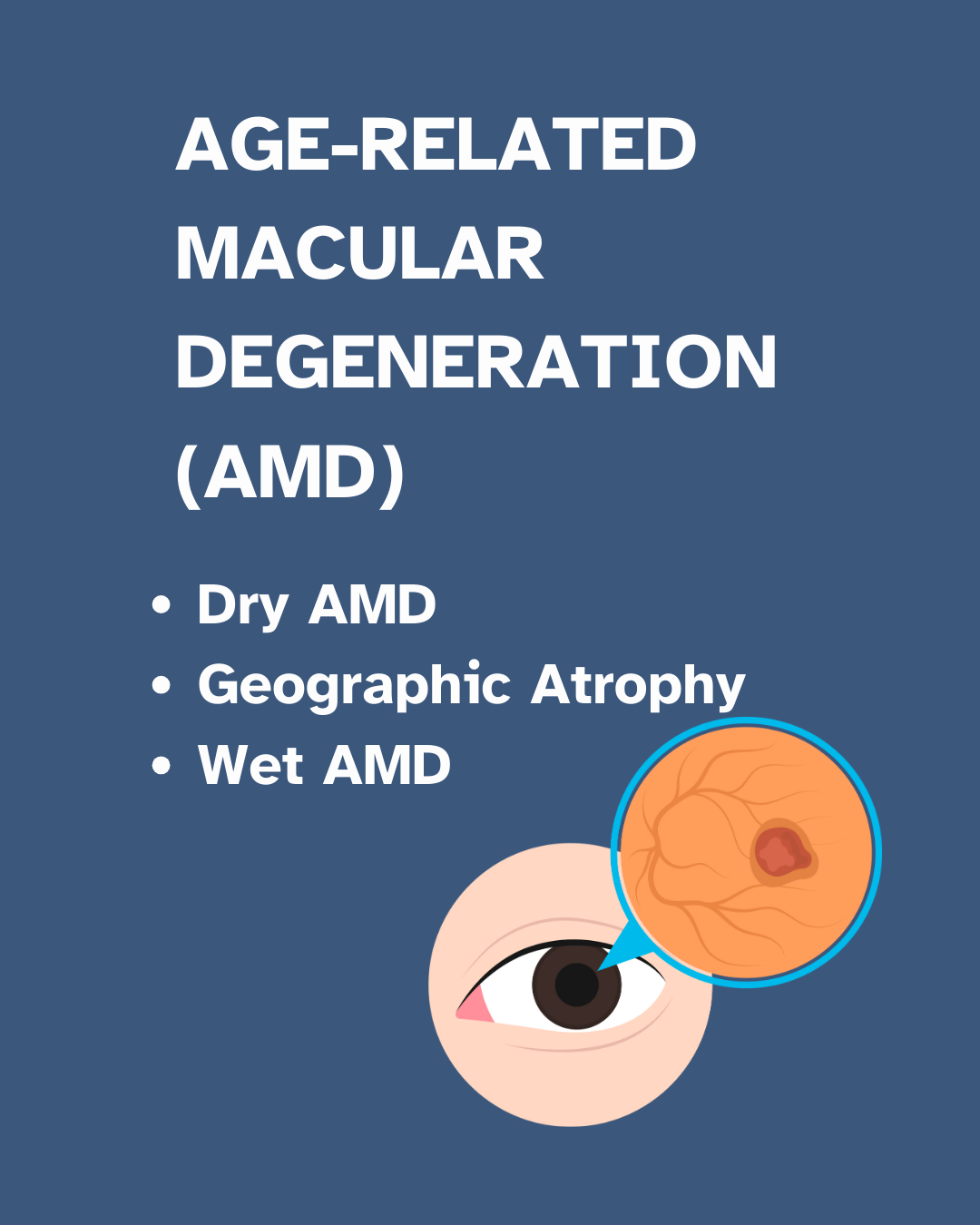 Understanding Age-Related Macular Degeneration- Dry, Geographic Atrophy ...